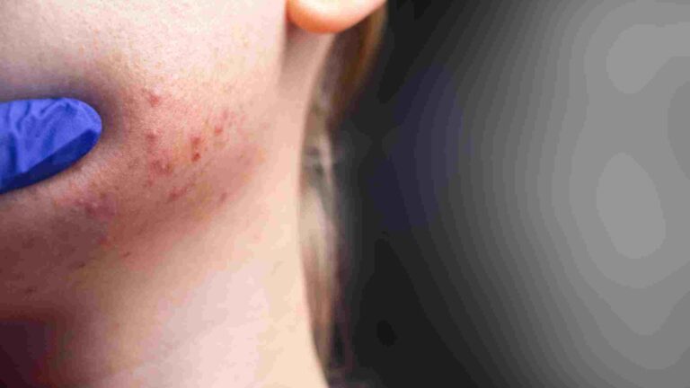 Acne On The Chin: These Are The Causes And How You Can Get Rid Of It
